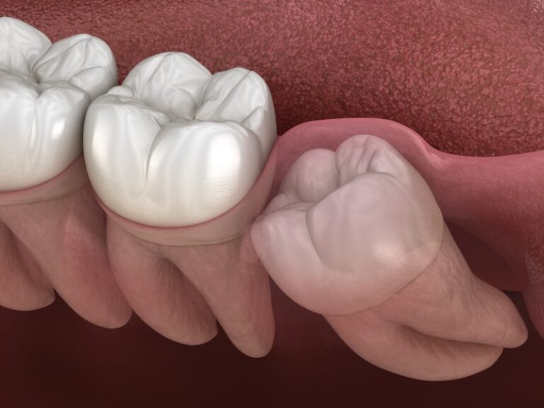 Sidewinder: Why Do Some Wisdom Teeth Come in Sideways? | Sheng Ji, DDS ...